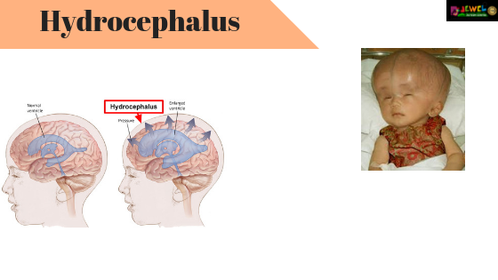 Hydrocephalus | Causes Hydrocephalus | How is hydrocephalus treated